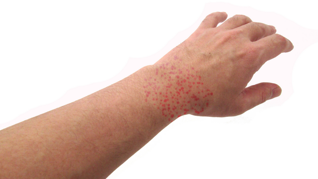 Solar Urticaria Dealing With Sun Allergy? Know The Causes, Symptoms